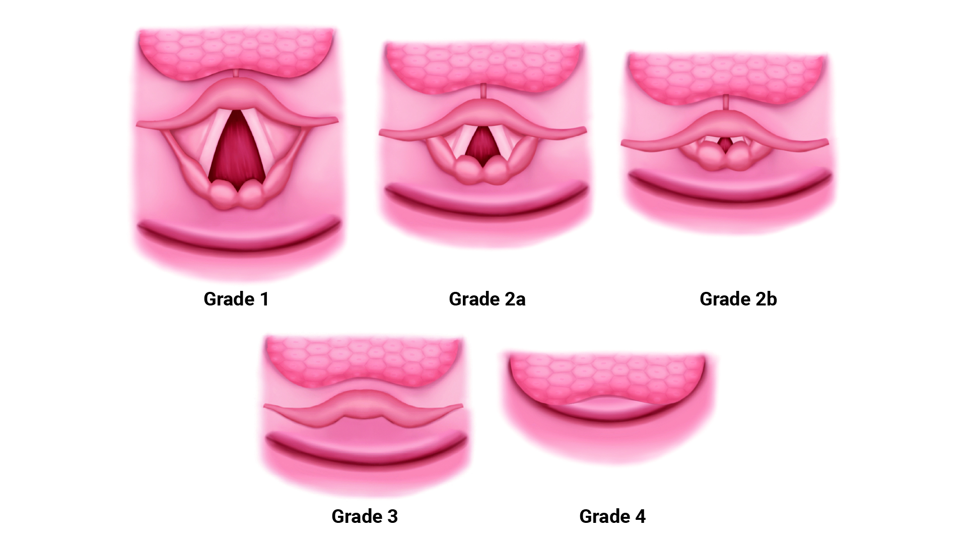 Intubation View