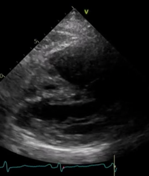 Right Ventricular Systolic Function Part 1 Of 3 Openanesthesia