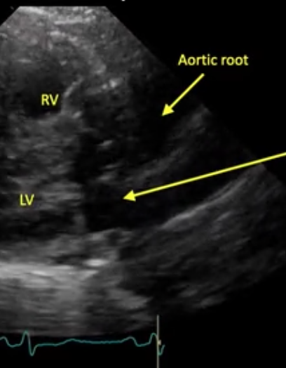 Right Ventricular Systolic Function Part 2 Of 3 Openanesthesia