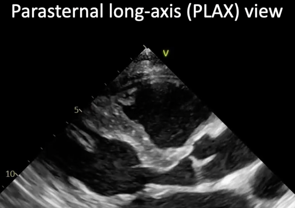 Left Ventricular Systolic Function Assessment Part 1 Of 3 Openanesthesia
