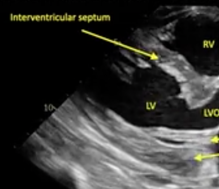 Left Ventricular Systolic Function Assessment Part 2 Of 3 Openanesthesia
