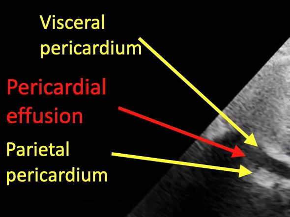 Point Of Care Ultrasound Evaluation Of Pericardial Effusion Part 1
